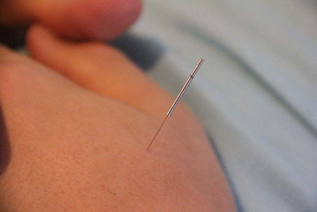 TCM Acupuncture - Suns Acupuncture